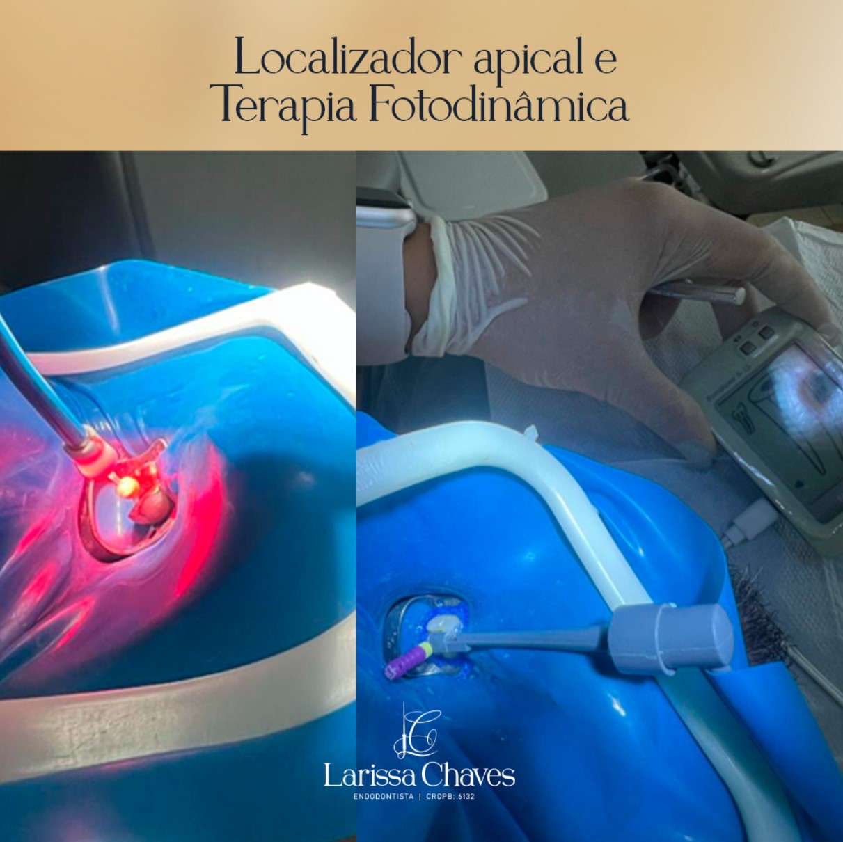 Localizador Apical: Precisão e Eficiência no Tratamento de Canal - Dra ...